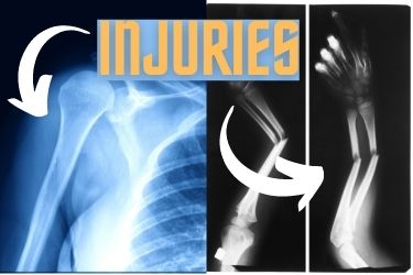 What Are The Most Common Arm Wrestling Injuries? – Arm Wrestling ...